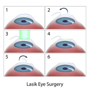 LASIK Eye Surgery Pittsburgh | LASIK Charleroi | Dr. Gipson | NeoVision